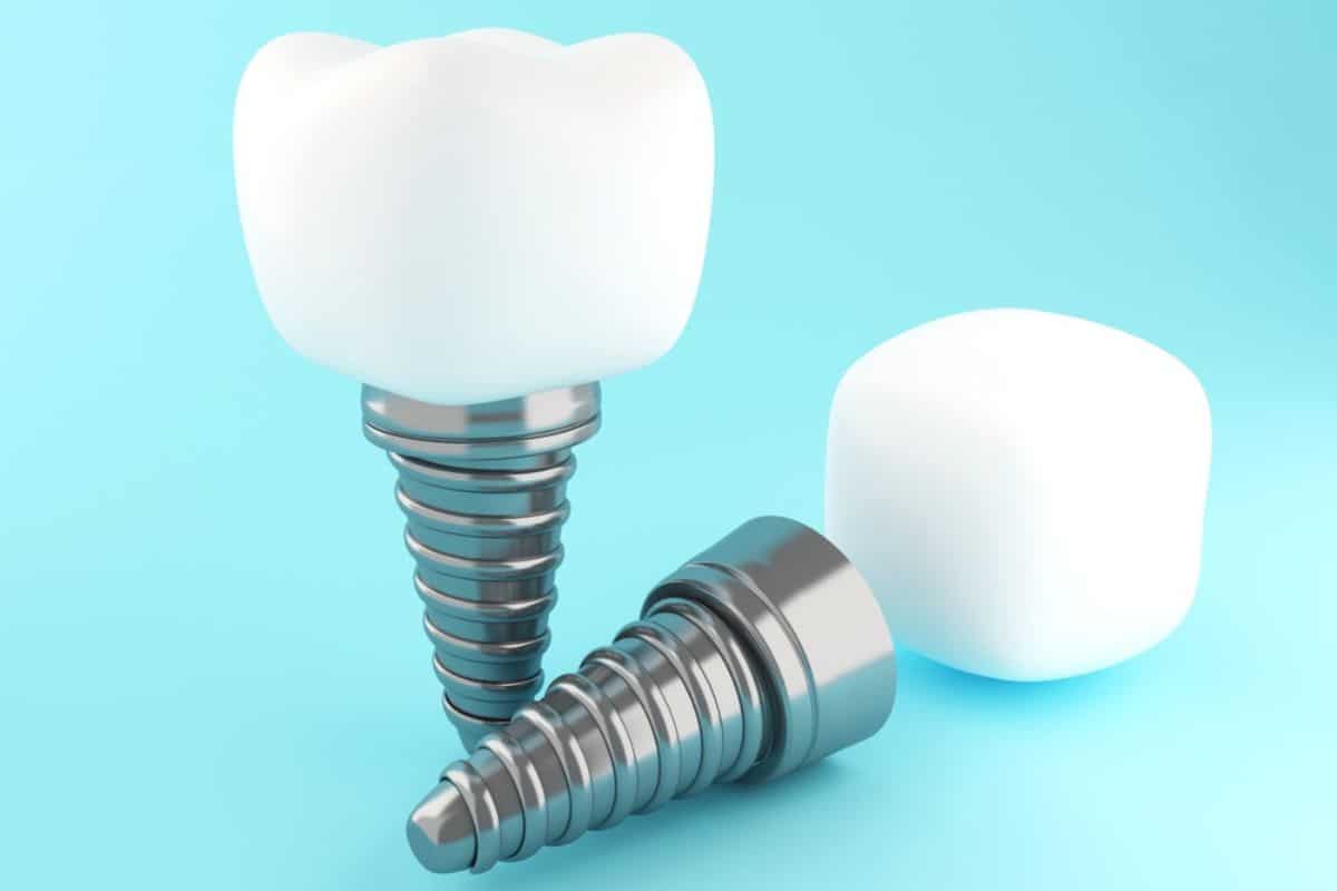 What Is a Dental Implant Screw? A Simple Guide for Patients