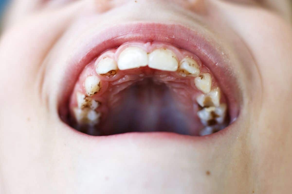 Black Lines On Teeth: Causes, Prevention, And Treatments