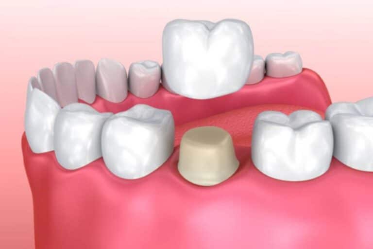 Can You Get A Crown On Your Front Tooth? Expert Dental Advice