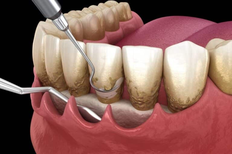 How to Get Plaque Off Teeth Without Hurting Your Gums?